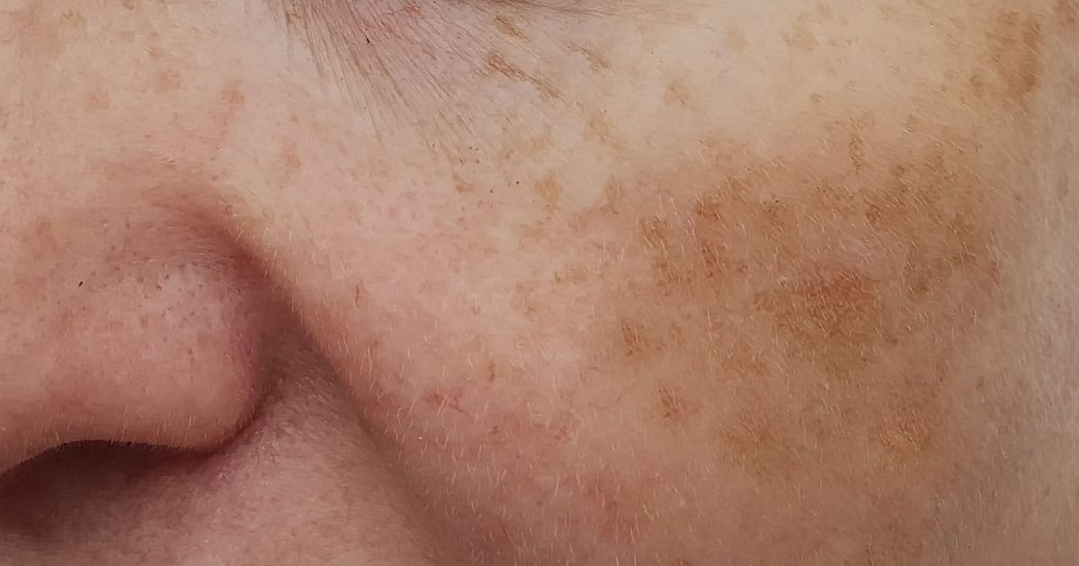 Hyperpigmentation Treatment Options - Melior Clinics