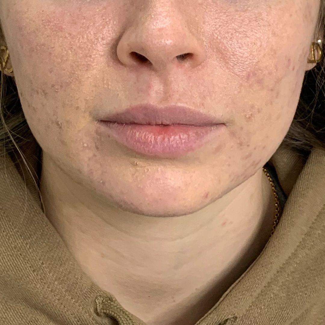 Botox For TMJ Disorder - Botox Injections for TMJ - Melior Clinics