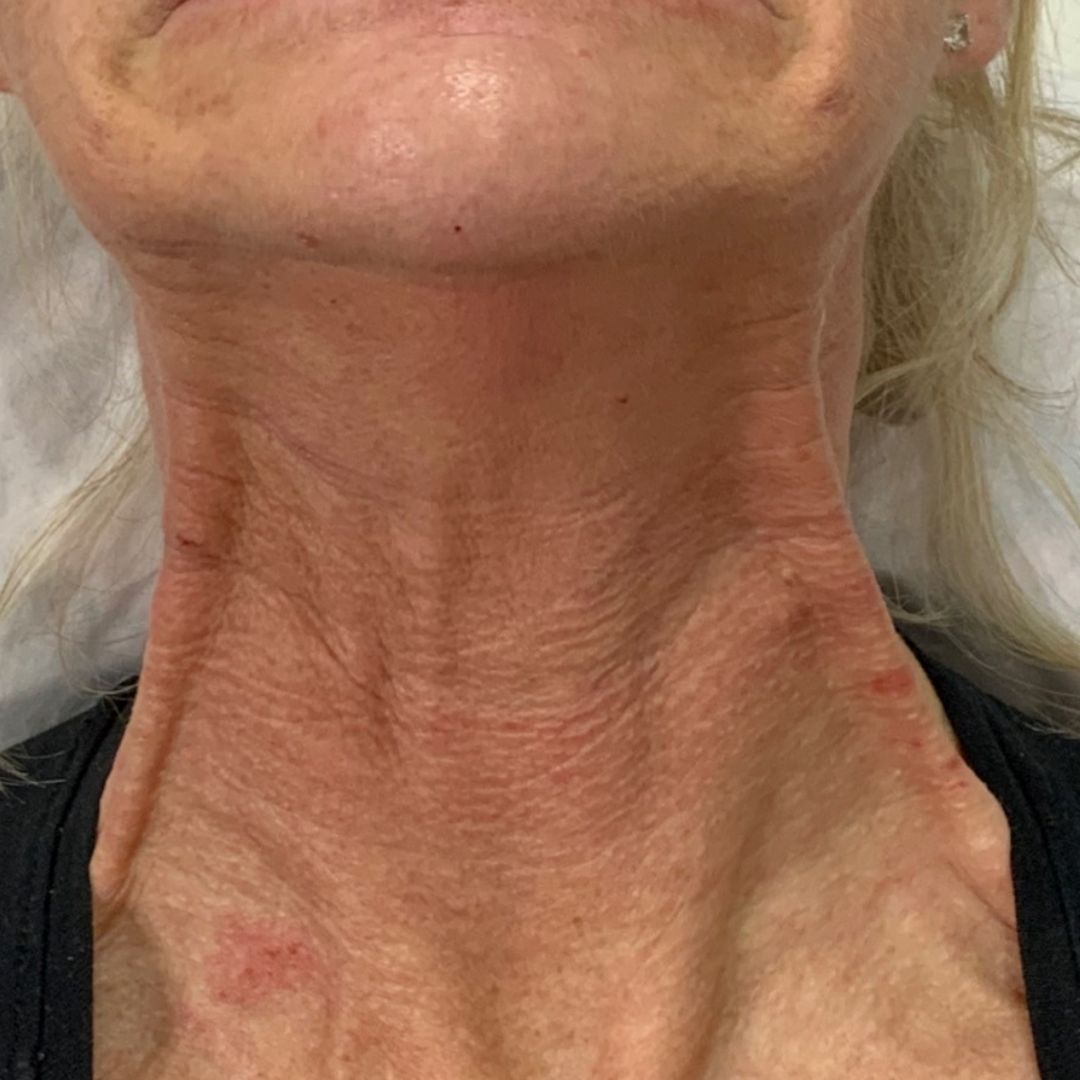 Botox Treatments - Anti Wrinkle Injections by Melior Clinics