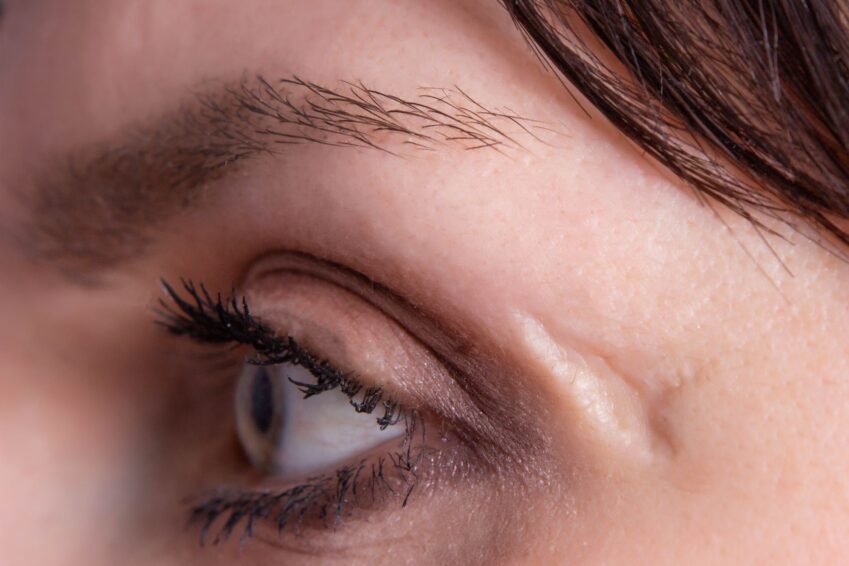 Scar Fillers - London, Sevenoaks, Cambridgeshire - Melior Clinics