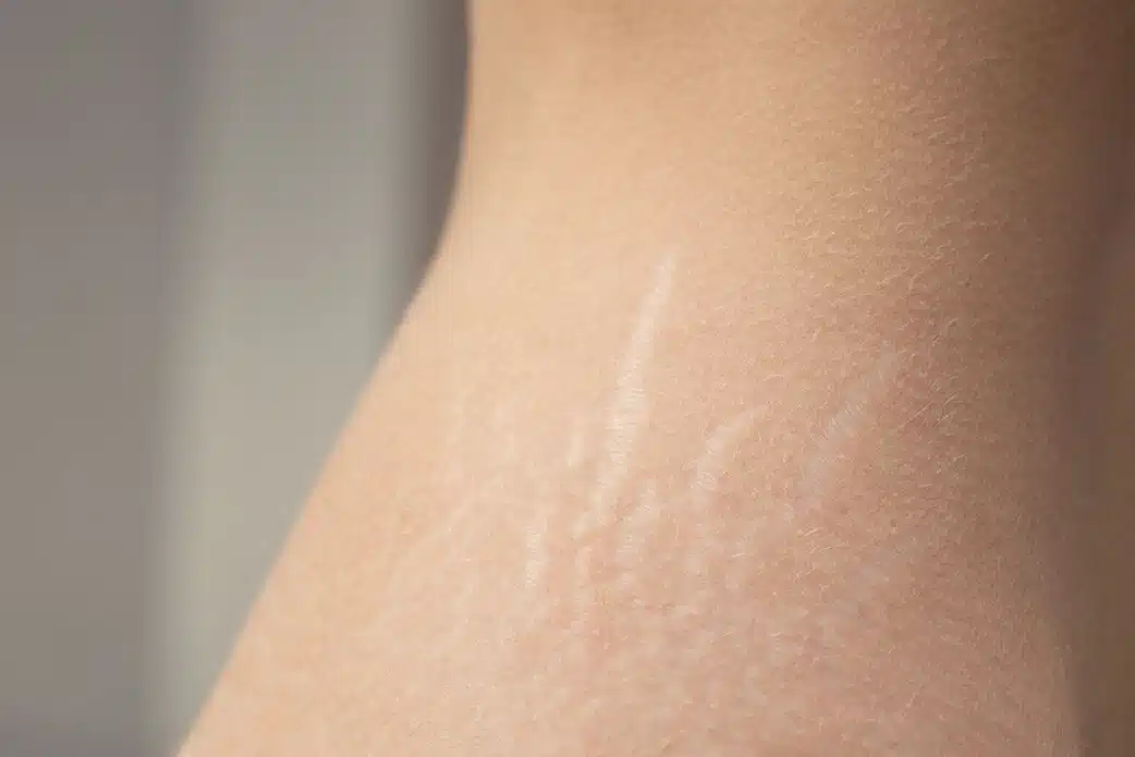Treatments For Stretch Marks - Melior Clinics